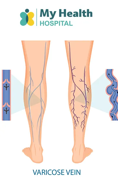 Varicose Veins Treatment in Kukatpally | Advanced Care Near You